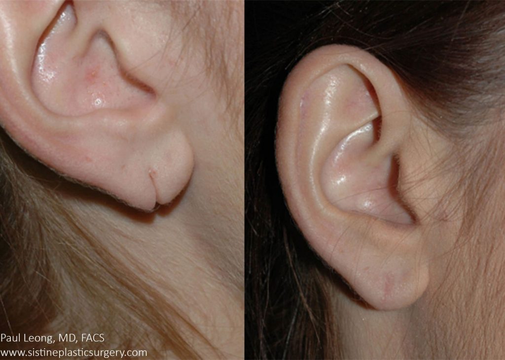Stretched or Torn Earlobes? ...There's a Solution! - Sistine Facial ...