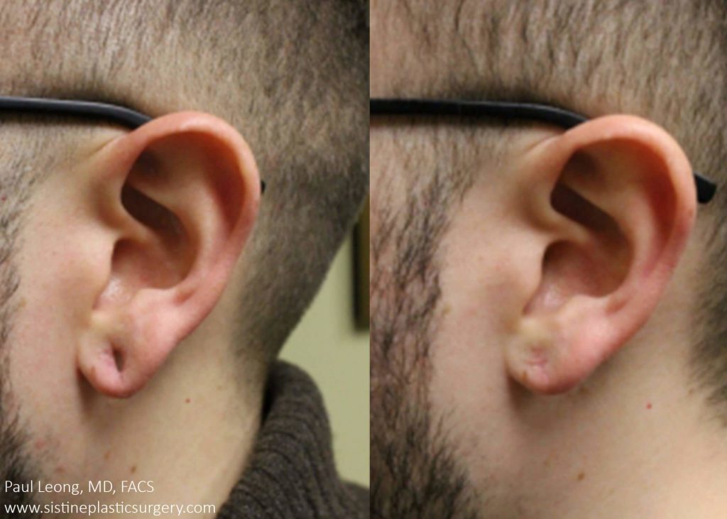 Stretched or Torn Earlobes? ...There's a Solution! - Sistine Facial ...